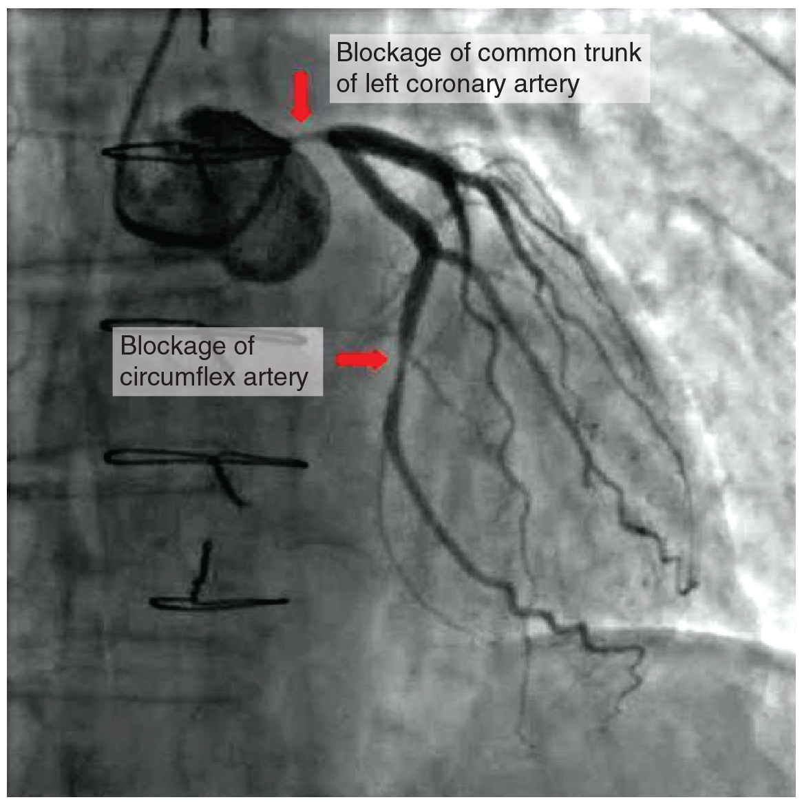 What Is A Coronary Angiogram? Indications, Procedure, Risks