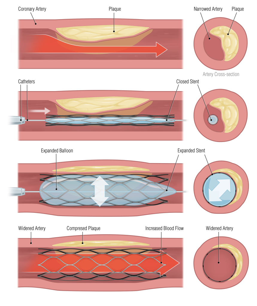 Coronary Angioplasty Stent Insertion Procedure Risks And Benefits Coronary Angioplasty Stent Insertion Procedure Risks And Benefits