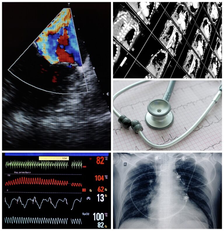The Electrocardiogram explained - What is an ECG?